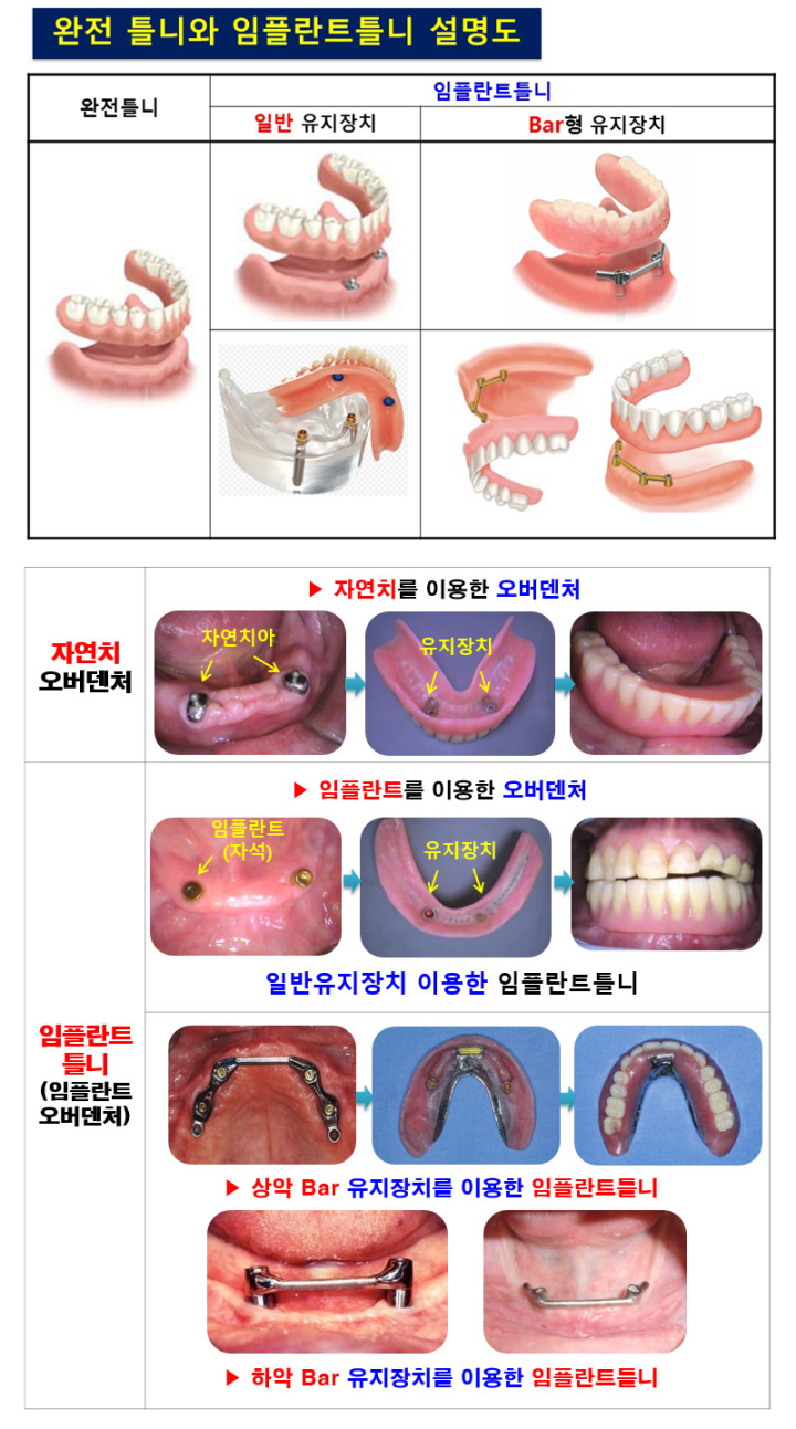 임플란트틀니종류 박강석치과의원박강석치과