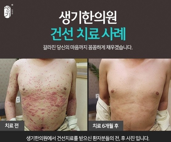 노원건선치료 생기한의원 노원점