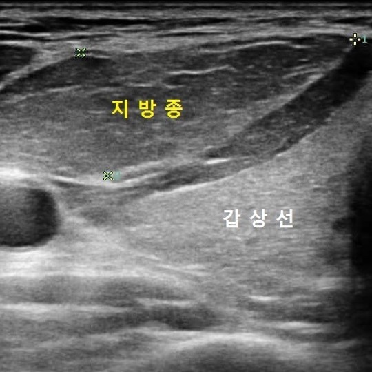 지방종수술 땡큐서울의원이비인후과내과