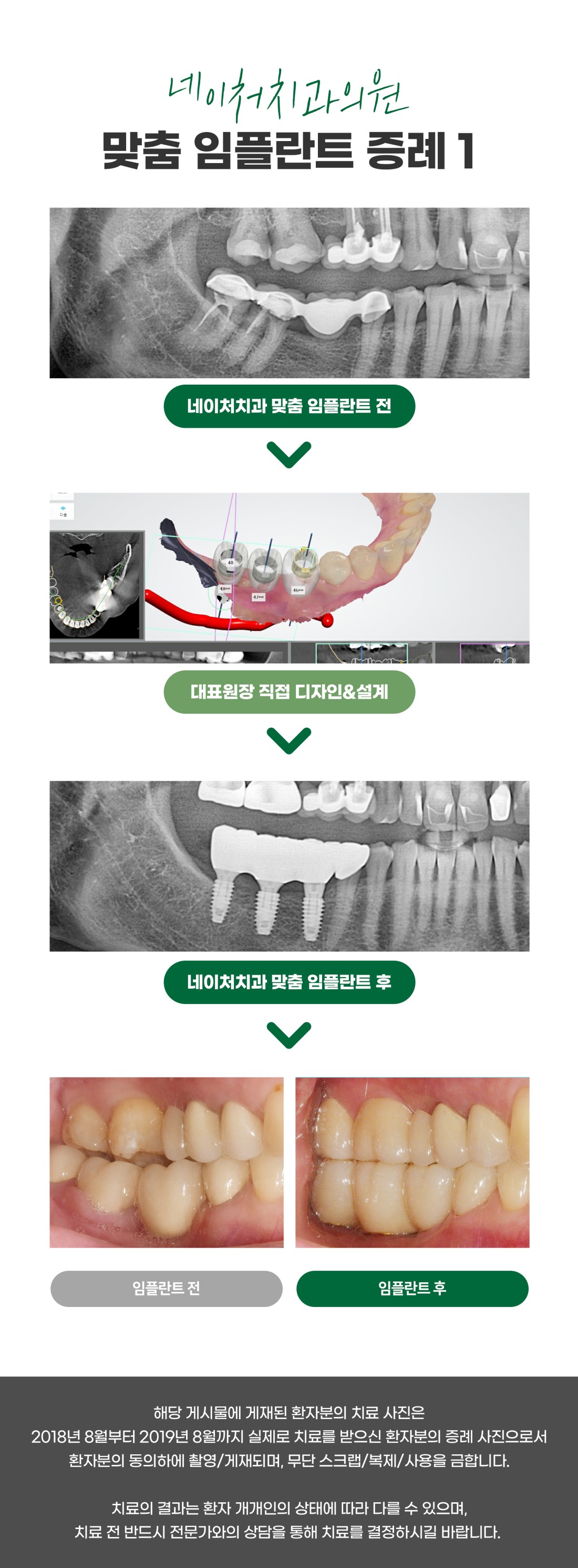임플란트 증례 1 네이처치과의원
