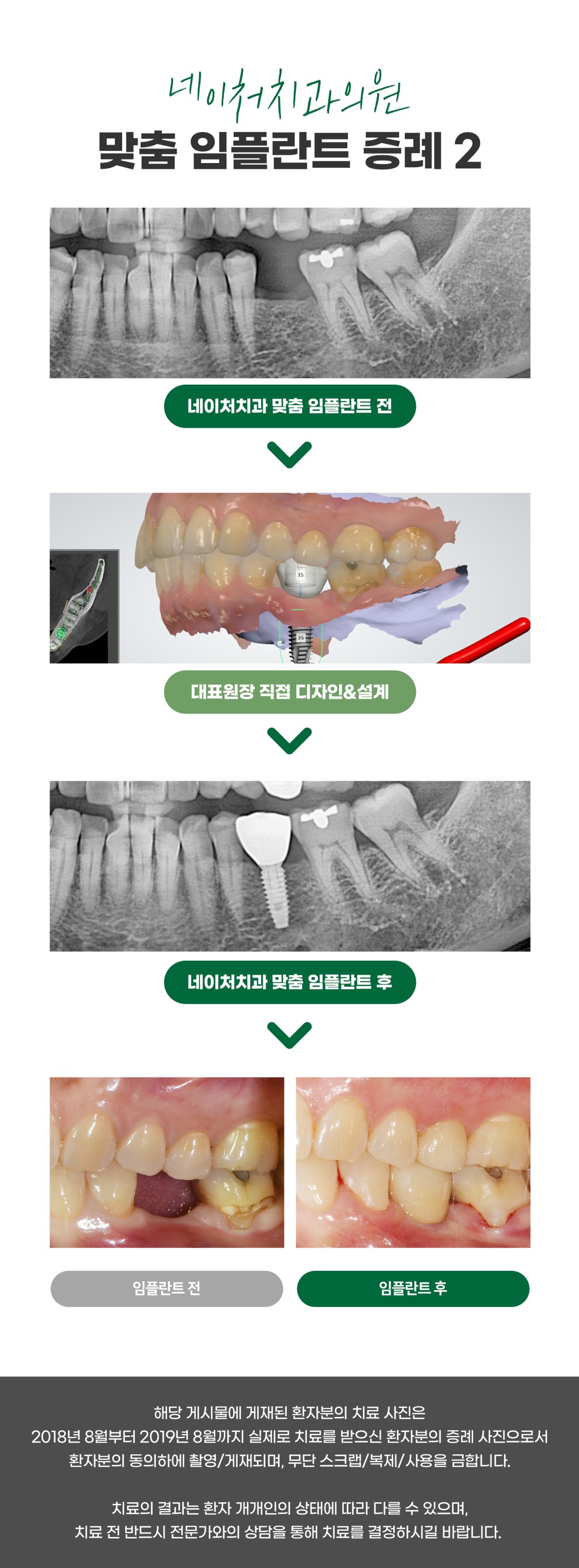 임플란트 증례 2 네이처치과의원