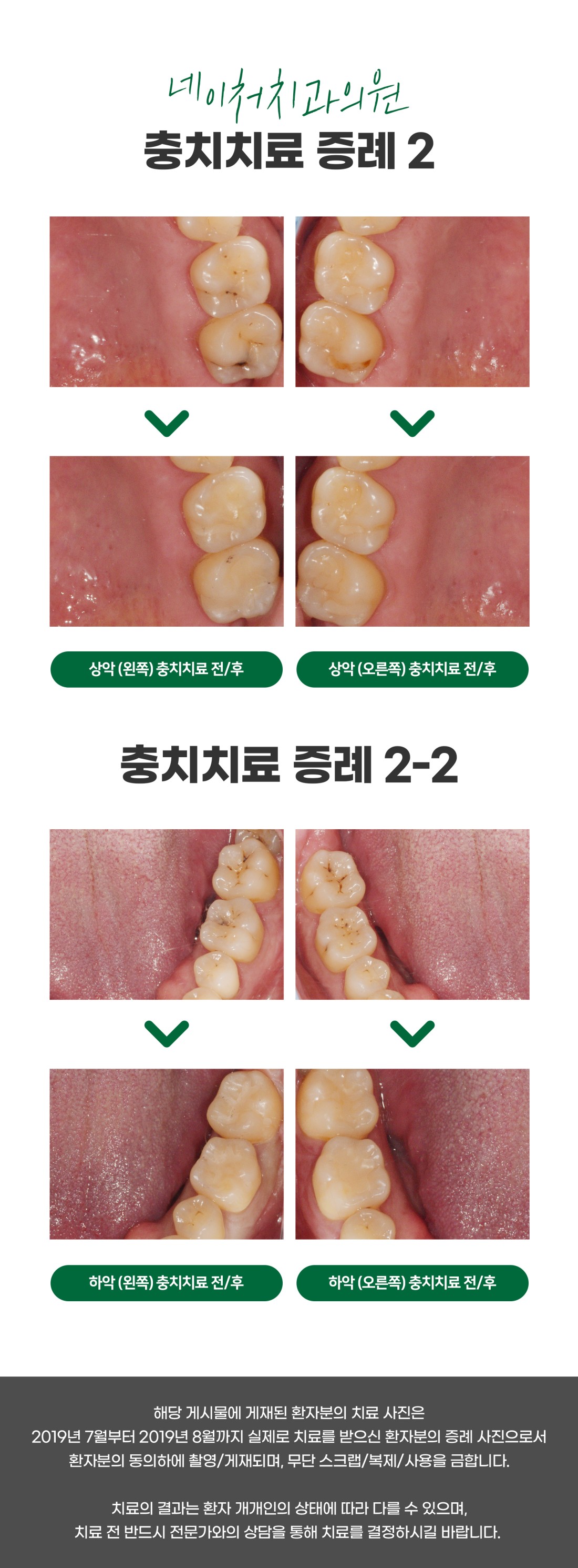충치치료 증례 2 네이처치과의원