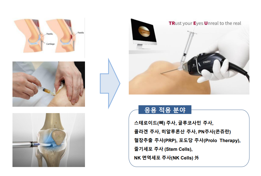줄기세포 관절주사 리파정형외과 리파스템